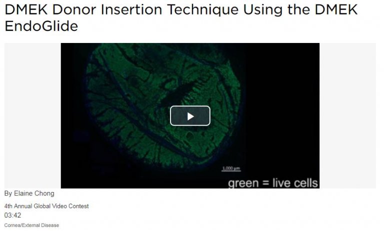 DMEK Donor Insertion Technique Using the DMEK EndoGlide (with video ...